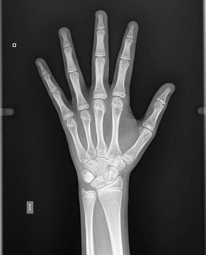 Radiografía de Muñeca - Diagnóstico Bucofacial